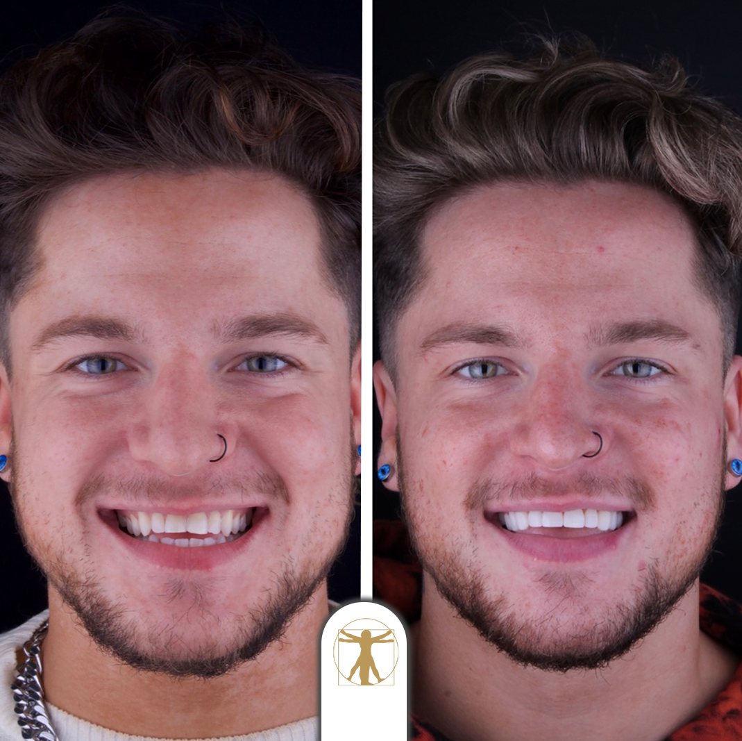 Smile Transformation | Dental Makeover | Aesthetic Dentistry